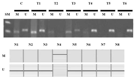 Loss Of RUNX Is Significantly Associated With Advanced Tumor Grade And Stage In Endometrial Cancers