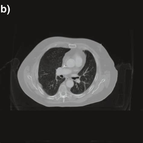 Simulated Planning Images With Geometric Distortion A Original Ct Download Scientific
