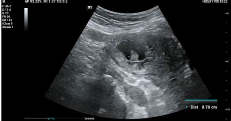 Oh Man Interstitial Ectopic — Kwak Talk