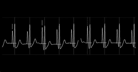 How To Locate The Tip Of A Picc Campus Vygon Global