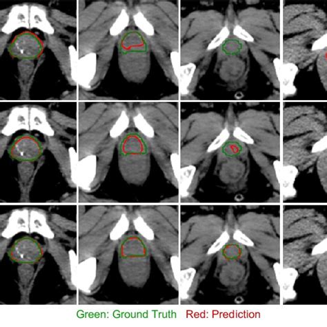 qualitative results of prostate segmentation by comparing our