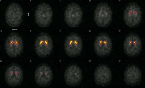 What Is A Dat Scan Radiology At Julia Bowman Blog