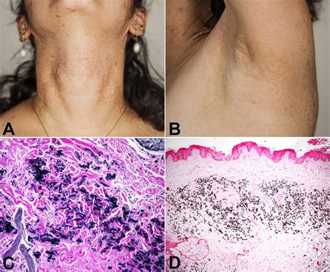 Pseudoxanthoma Elasticum Histology