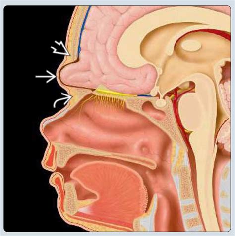 Frontoethmoidal Cephalocele Otolaryngology Secrets