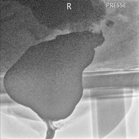Low Enterocele And Anterior Rectocele On Defecography Eurorad