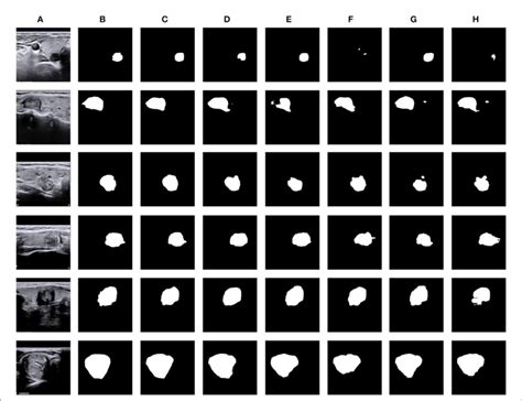 Sual Comparison Of Thyroid Nodule Segmentation Results Generated From