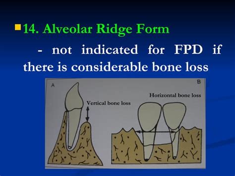 1 Fixed Partial Denture Finals1 Ppt Dental Health Diseases And