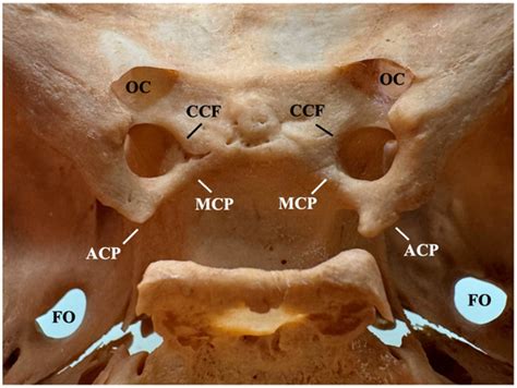 Prevalence And Morphology Of Ossified Caroticoclinoid Ligament An