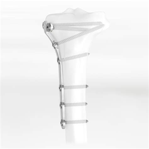 Medial Proximal Tibia Intrauma