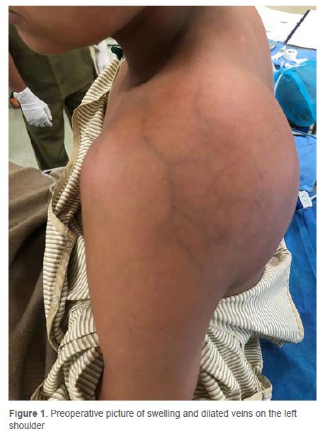 3d Printing In Osteosarcoma Of The Scapula A Unique Case