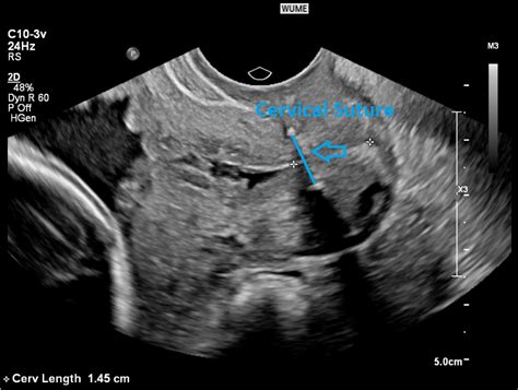 Ultrasound In Pregnancy Womens Ultrasound Melbourne