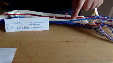 Infiltration Vs Extravasation 151 Youtube