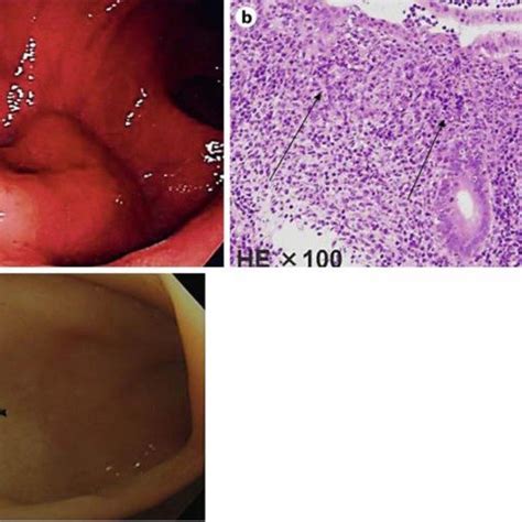Case 3 A Colonoscopy Showing A Sessile Elevated Lesion With