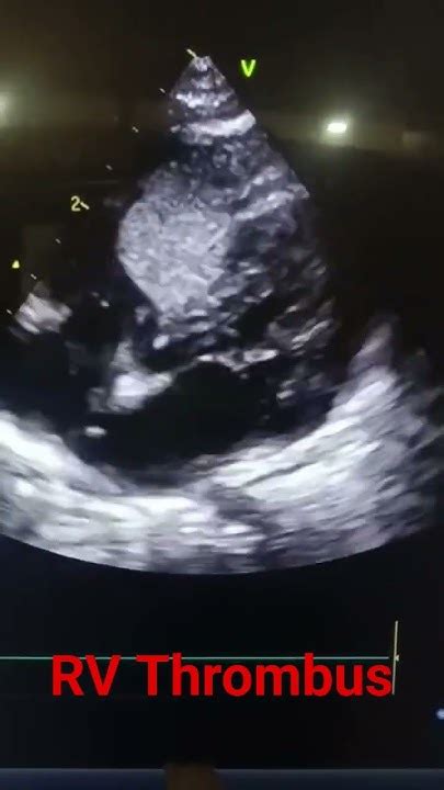 Right Ventricular Thrombus In Echo Youtube