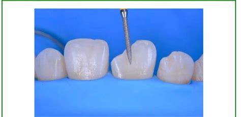 Preparation Of The Tooth Structure