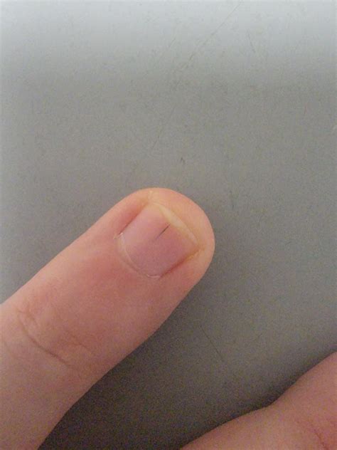 Black Line Under Nail Rdermatologyquestions