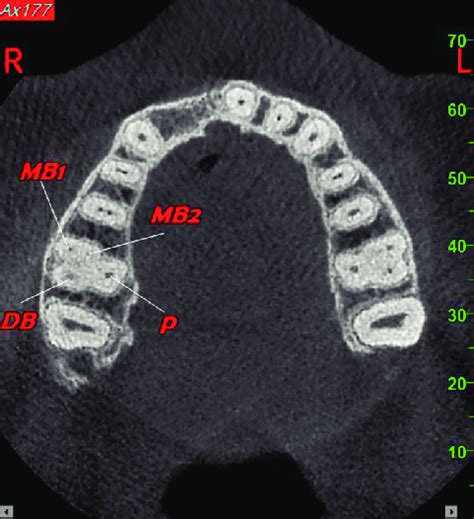 Evaluation Of The Number Of Canals And Presence Absence Of Second Download Scientific Diagram