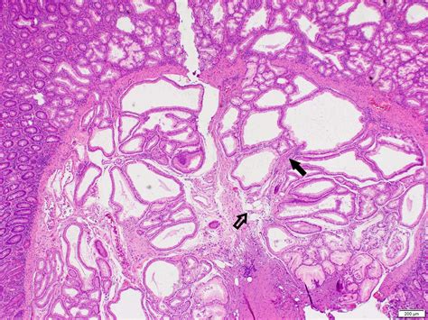 Brunner Gland Adenoma Of Duodenum At Priscilla Roberts Blog