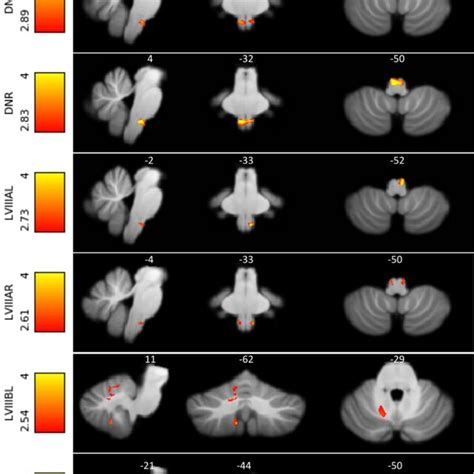 Significant Functional Connectivity Differences Between Healthy Download Scientific Diagram