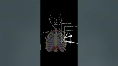 Key Steps For A “robotic Thymectomy For Myasthenia Gravis Medicine Learn Doctor Surgeon