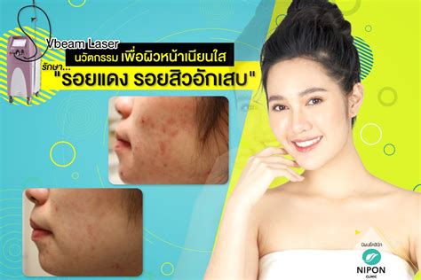 😱รอยแดง รอยสิวอักเสบ ‼️ ⚡️vbeam Laser Nipon Skin Clinic