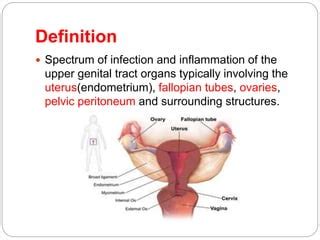 Management Of Acute Pid PPT