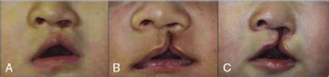 Classification For Cleft Lip Based In The Severity Of The Cleft A Download Scientific