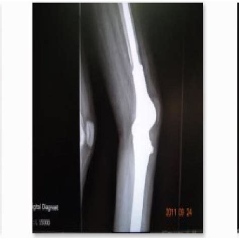 An 18 Year Old Female With Proximal Tibia Ewings Sarcoma Download