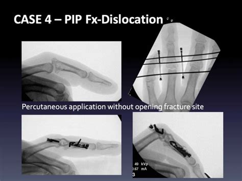 PIP Fracture Dislocation Archives Virak Orthopedics
