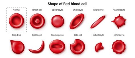 Variasi Bentuk Morfologi Sel Darah Merah Eritrosit Normal Dan Abnormal Sel Target Spherocyte