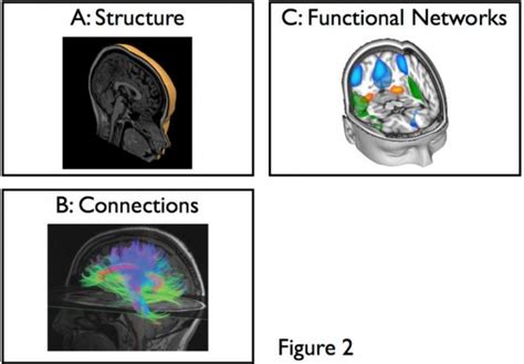 Early Dementia And Functional Brain Networks Libc Blog
