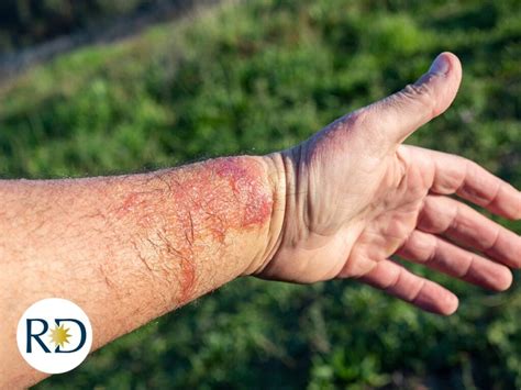 Phytophotodermatitis When Sun And Plants Cause A Reaction Revival Dermatology L Dallas