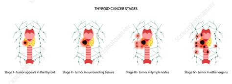 Thyroid Cancer Illustration Stock Image F036 3931 Science Photo