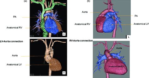 Images A Of Tga After Jatene Procedure With Lecompte Maneuver These