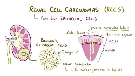 Renal Cell Carcinoma