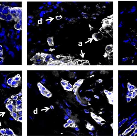 Ck Expression In Invasive Breast Carcinoma Of No Special Type Download Scientific Diagram