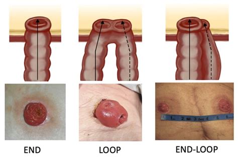 Loop Ileostomy Vs End Ileostomy