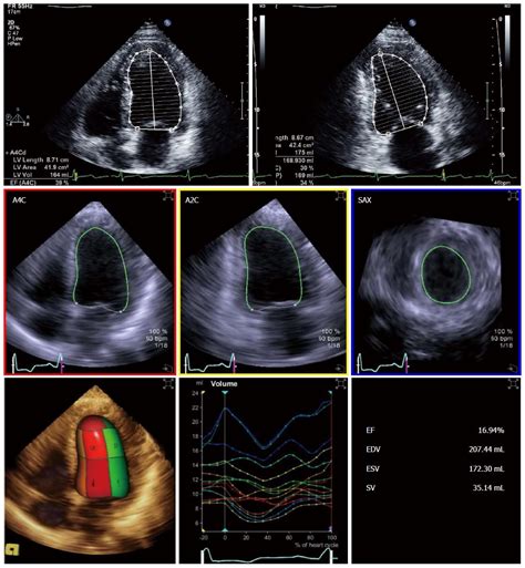Simpsons Method Echocardiography How To Use Simpsons Method Fiogn