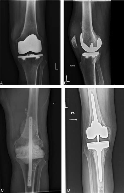 Lyme Disease A Potential Source For Culture Negative Prosthetic Joint