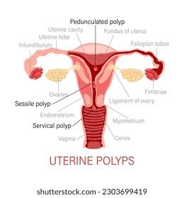 Types Uterine Polyps Diseases Female Reproductive Stock Vector Royalty Free 2303699419