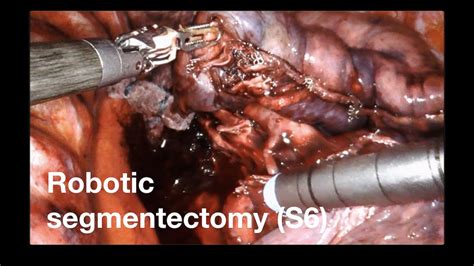 Robotic Pulmonary Segmentectomy S6 Youtube