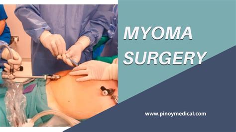 Myoma Surgery Price In The Philippines 2026 — Pinoymedical