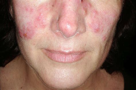 Trigeminal Neuralgia 10 Causes Of Trigeminal Neuralgia