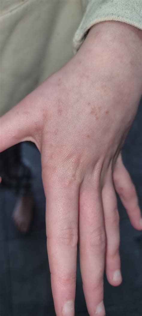 Took My Daughter To The Doctors And He Said This Was Scabies Im Not