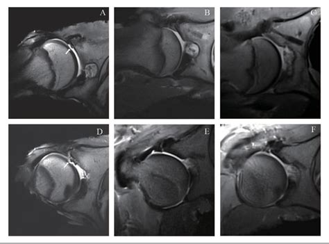 Figure 2 From The Cartilage Protective Effect Of Labrum Reconstruction