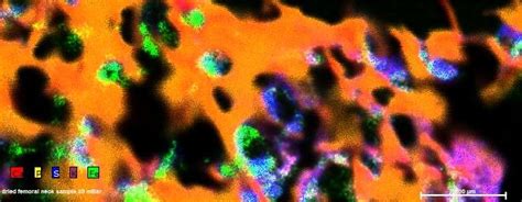 Femoral Neck Box Chisel Bone Specimen During A Total Hip Replacement