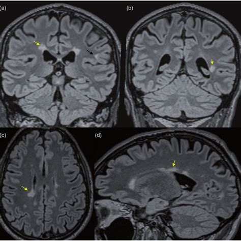 Brain Mri Performed In 2014 Showing Typical Multiple Sclerosis Lesions Download Scientific