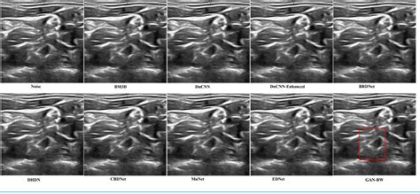 Figure 9 From Ultrasound Image Denoising Using Generative Adversarial