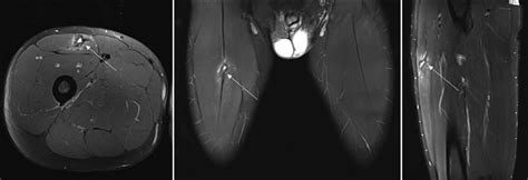 Magnetic Resonance Image Of Recurrent Rectus Femoris Central Tendon