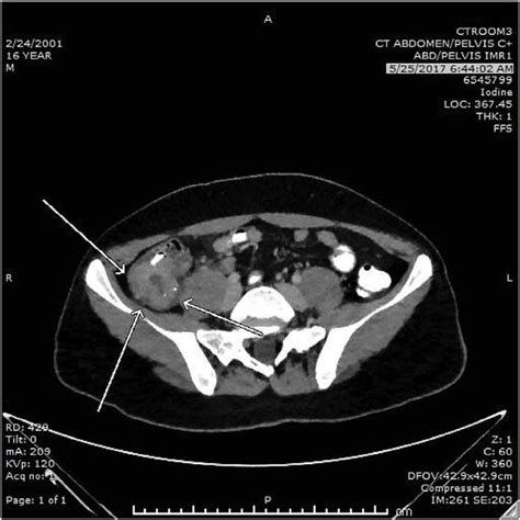 Ct Scan Shows Acute Appendicitis With Localized Perforation Marked